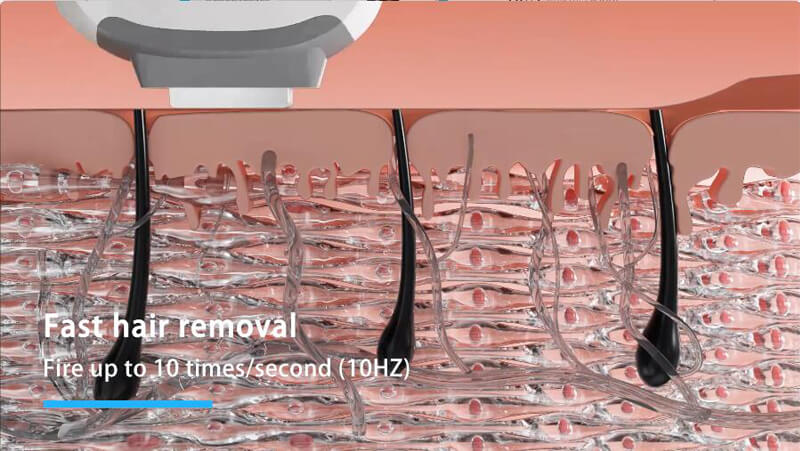 Professional IPL Laser Machine Manufacturer - BVLASER